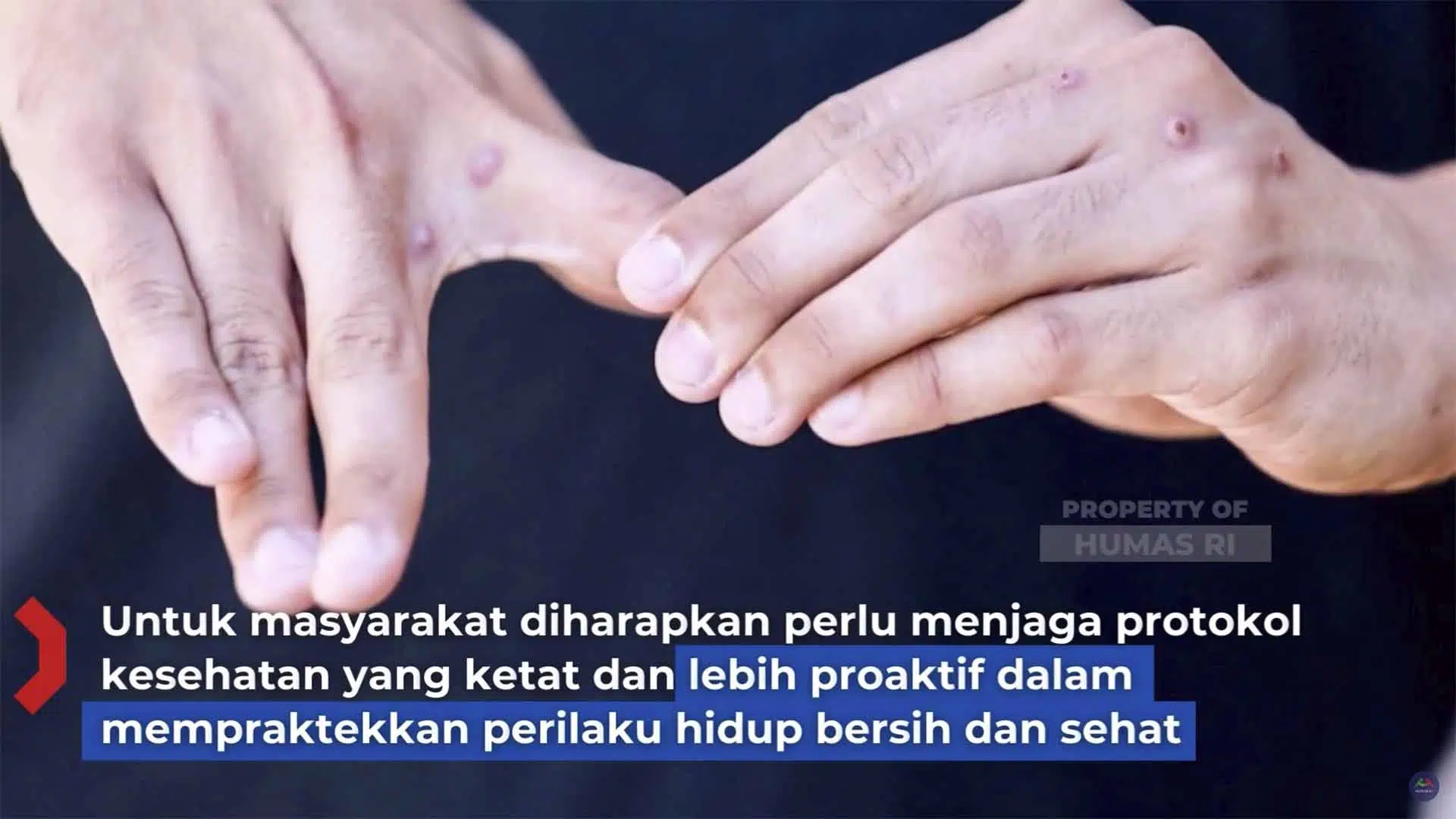 Kasus Cacar Monyet Pertama Terdeteksi di Indonesia • Waktu news